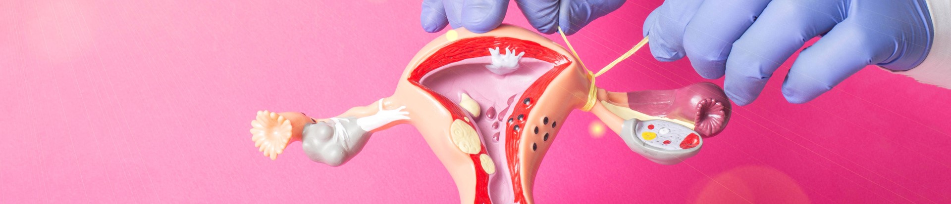 Permanent Contraception | 1800 My Options